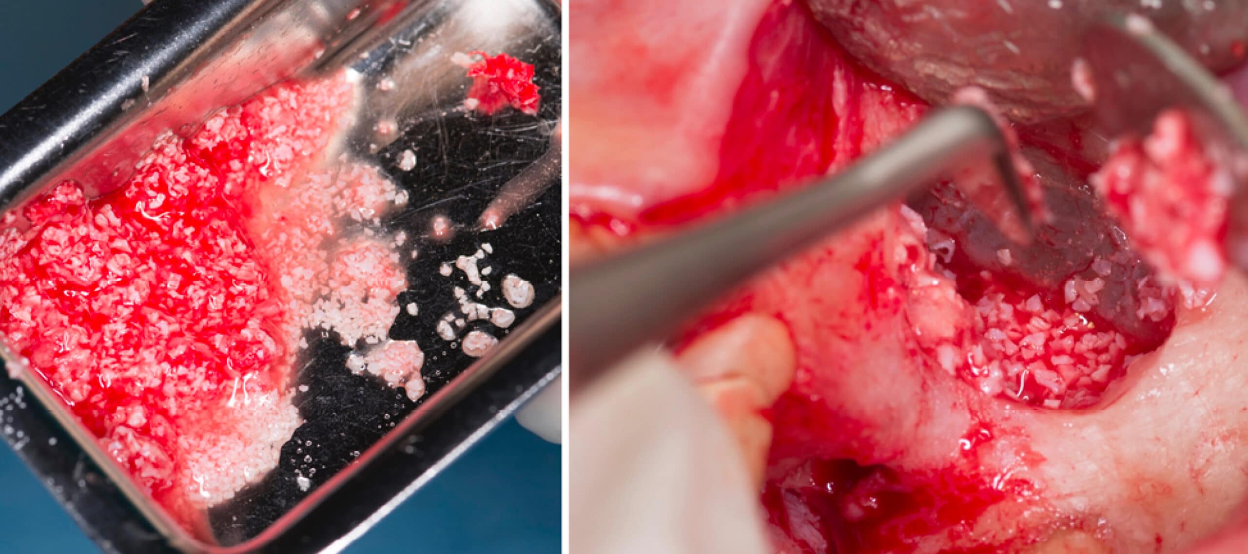 II Curso Intensivo de Elevación de Seno Maxilar - Vericat Instituto de Formación