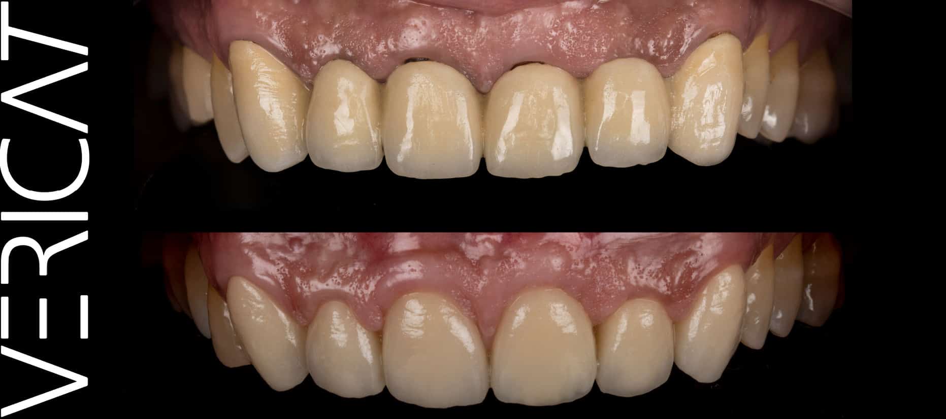 Técnica BOPT. Caso clínico - Vericat Instituto de Formación